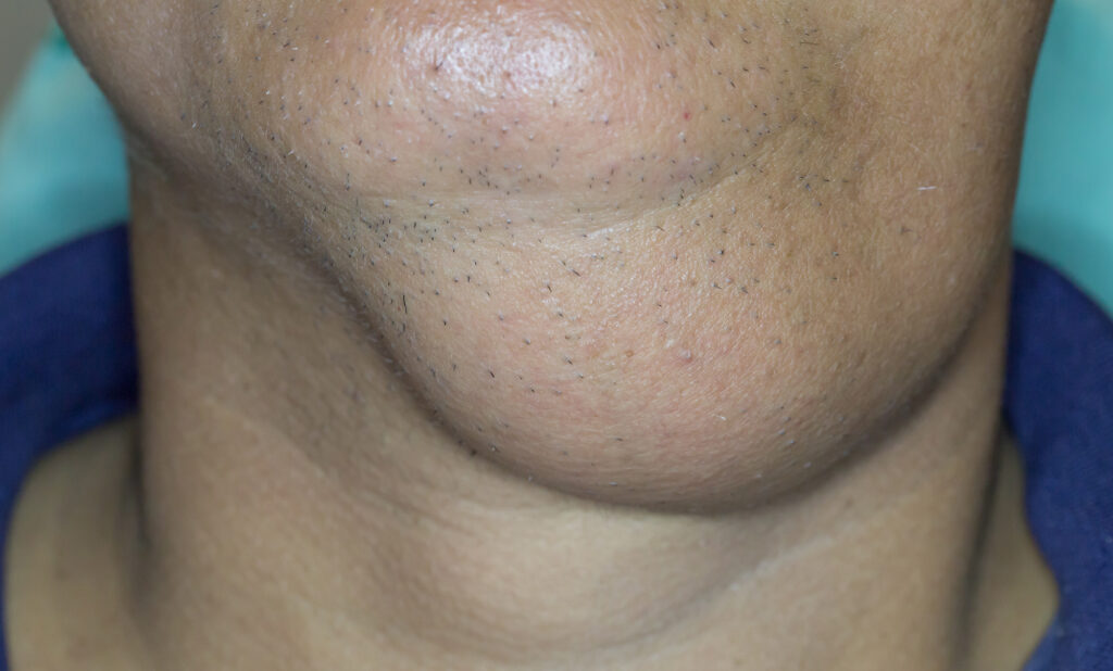 Salivary Gland Tumour Symptoms, Causes and Treatment